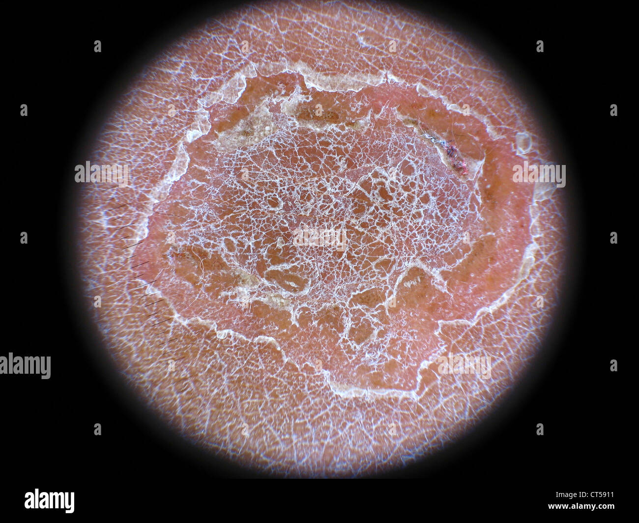 ICHTHYOSIS LINEARIS CIRCUMFLEXA Stock Photo - Alamy