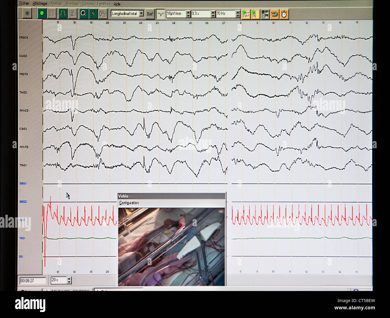 Electroencephalogram eeg hi-res stock photography and images - Alamy