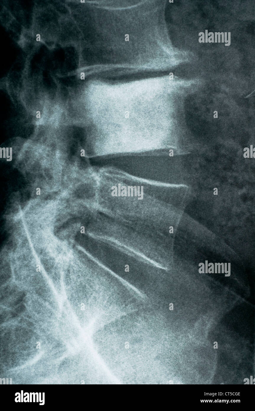 IVORY VERTEBRA, X-RAY Stock Photo - Alamy