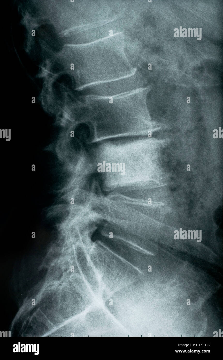 IVORY VERTEBRA, X-RAY Stock Photo - Alamy