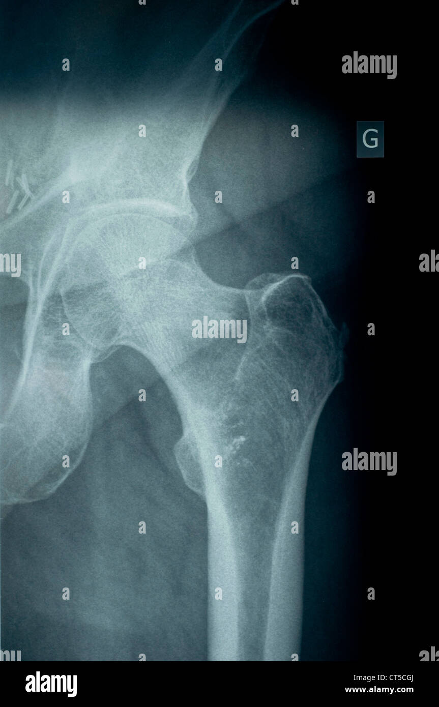 X Ray Left Hip