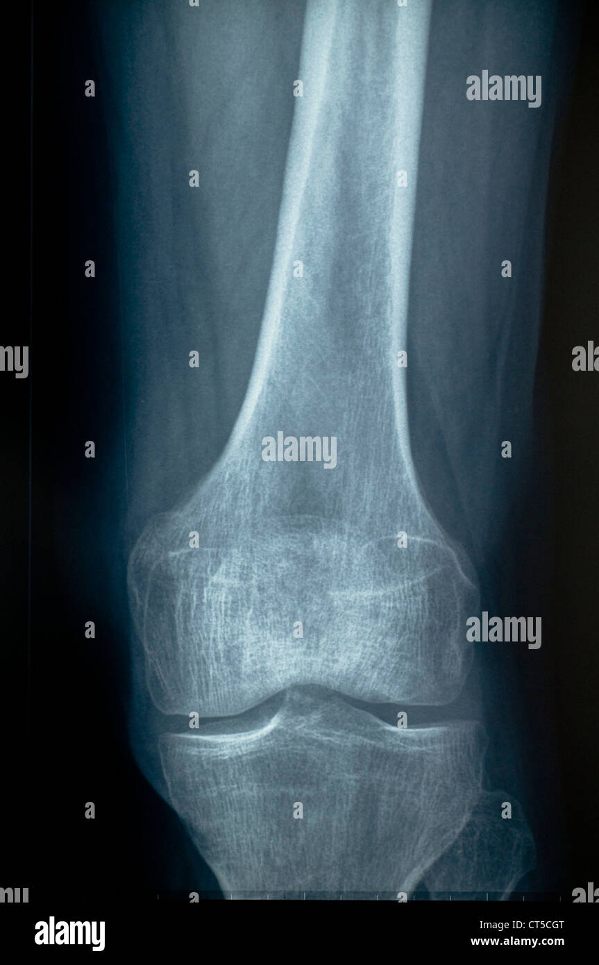 Normal knee x ray hi-res stock photography and images - Alamy