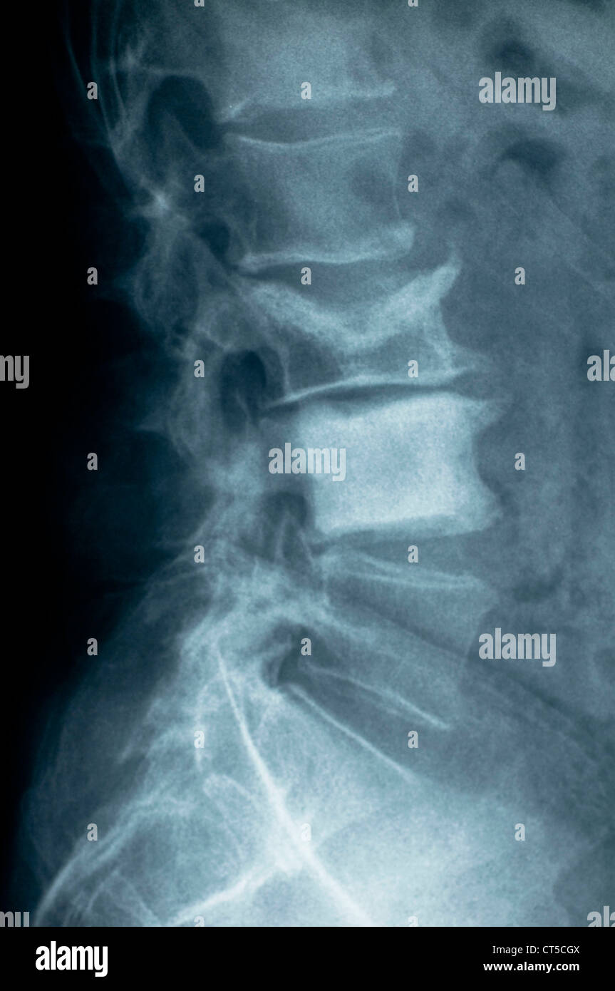 IVORY VERTEBRA, X-RAY Stock Photo - Alamy