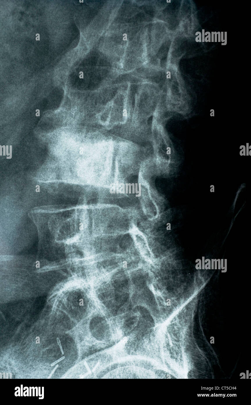 IVORY VERTEBRA, X-RAY Stock Photo - Alamy