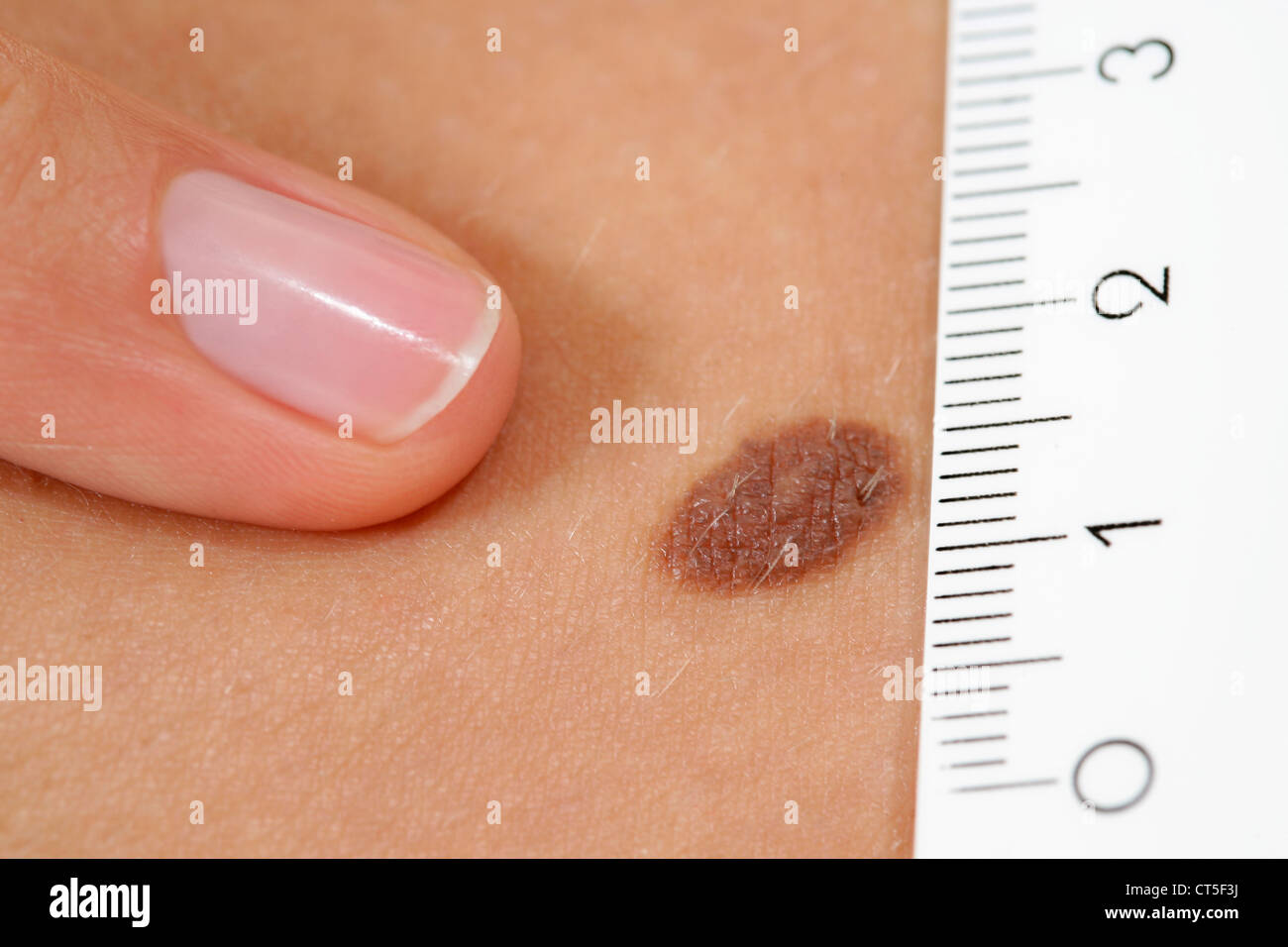 Nevocellular hi-res stock photography and images - Alamy