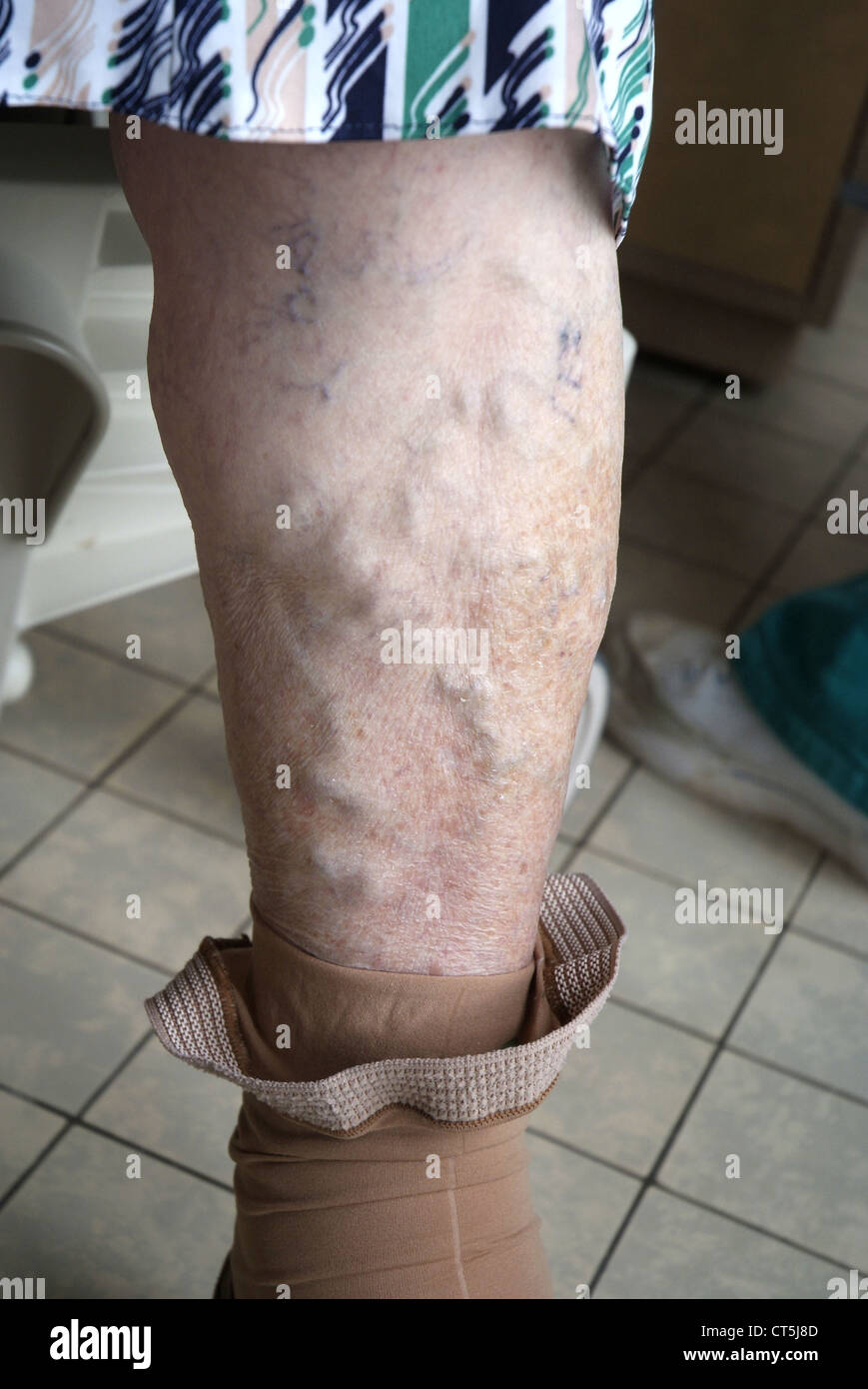 Varicose vein on leg hi-res stock photography and images - Alamy