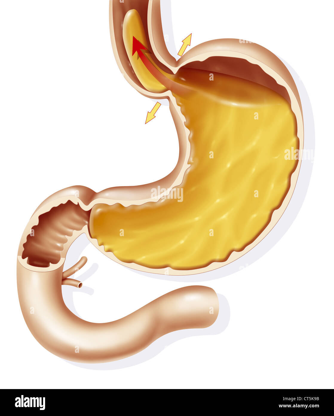 Gastroesophageal reflux disease hi-res stock photography and images - Alamy