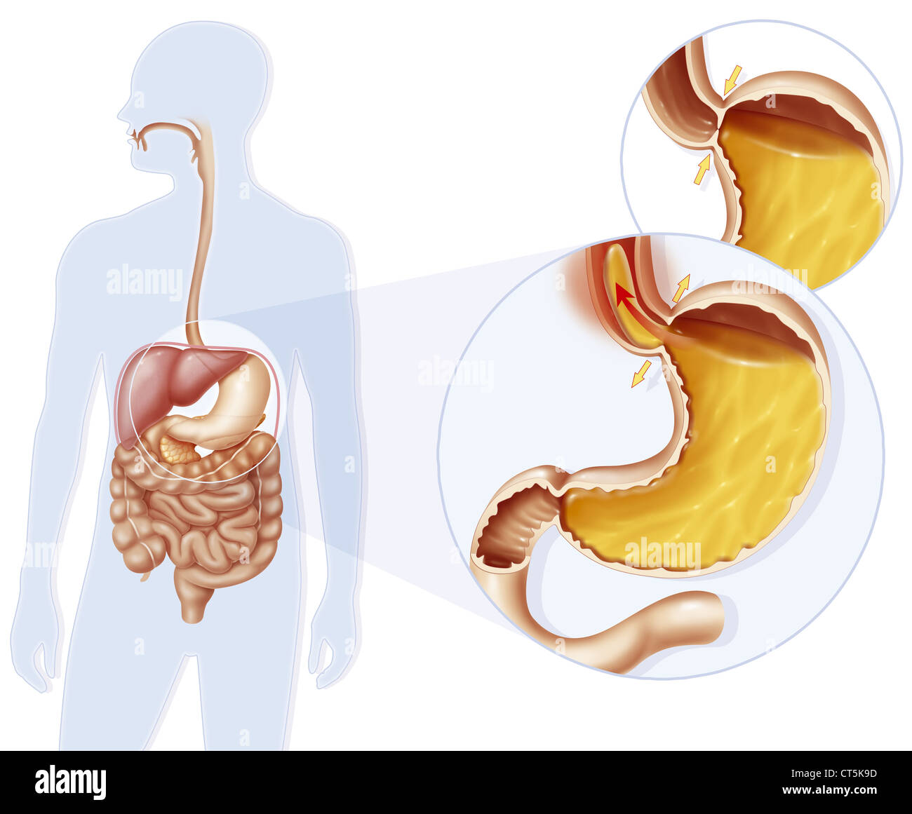 Gastroesophageal reflux disease gerd Cut Out Stock Images & Pictures ...