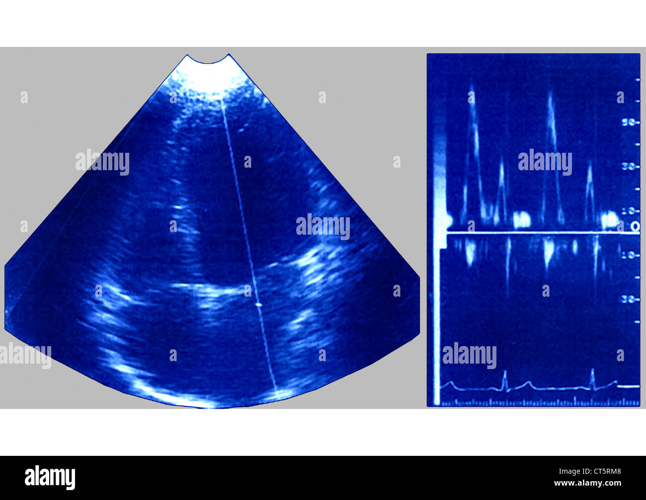 DOPPLER TEST, HEART Stock Photo - Alamy