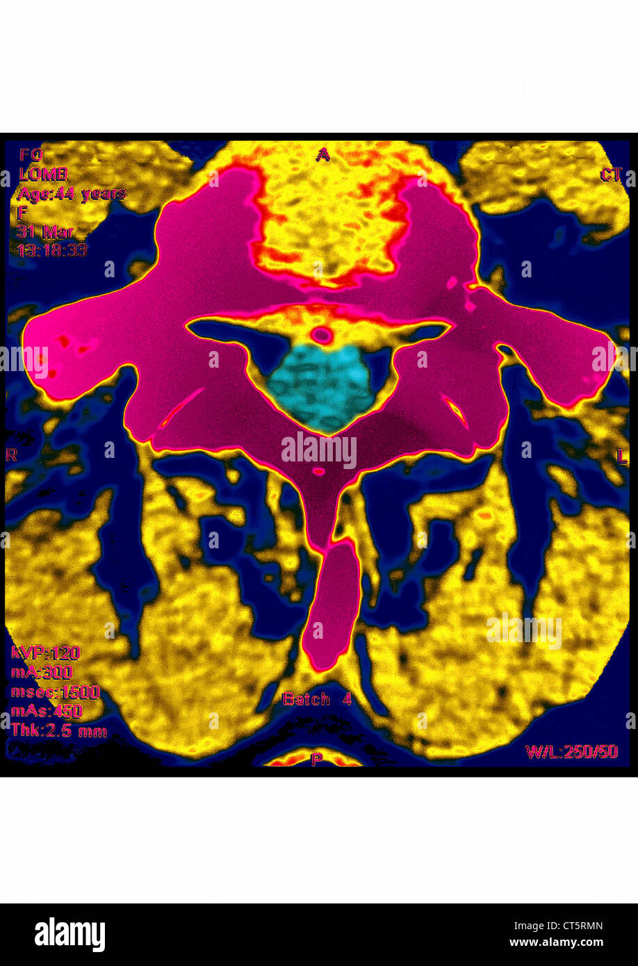 Herniated lumbar disc mri hi-res stock photography and images - Alamy