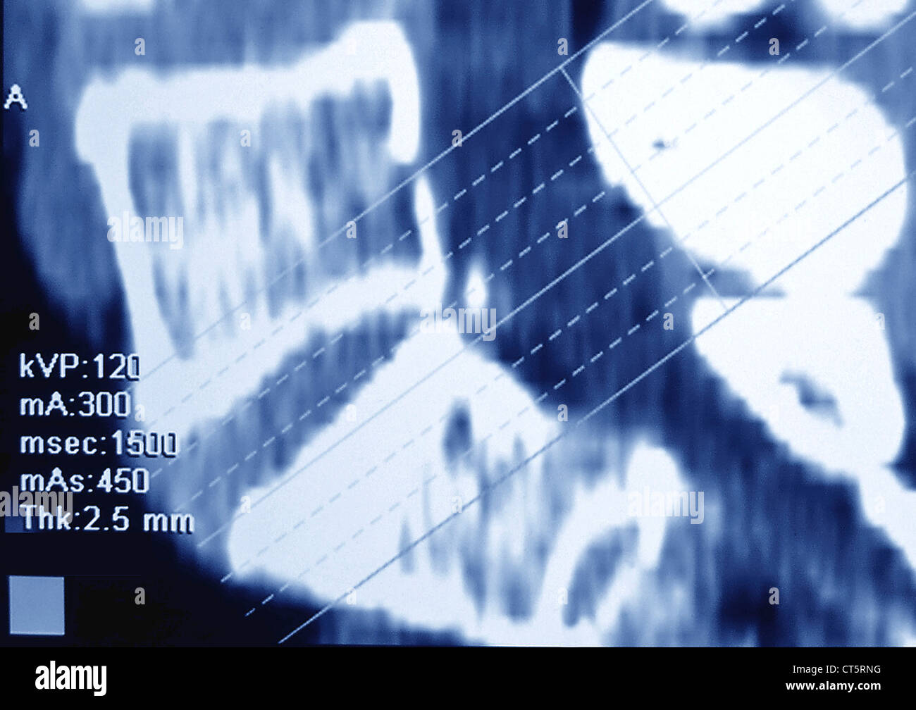 Herniated lumbar disc mri hi-res stock photography and images - Alamy