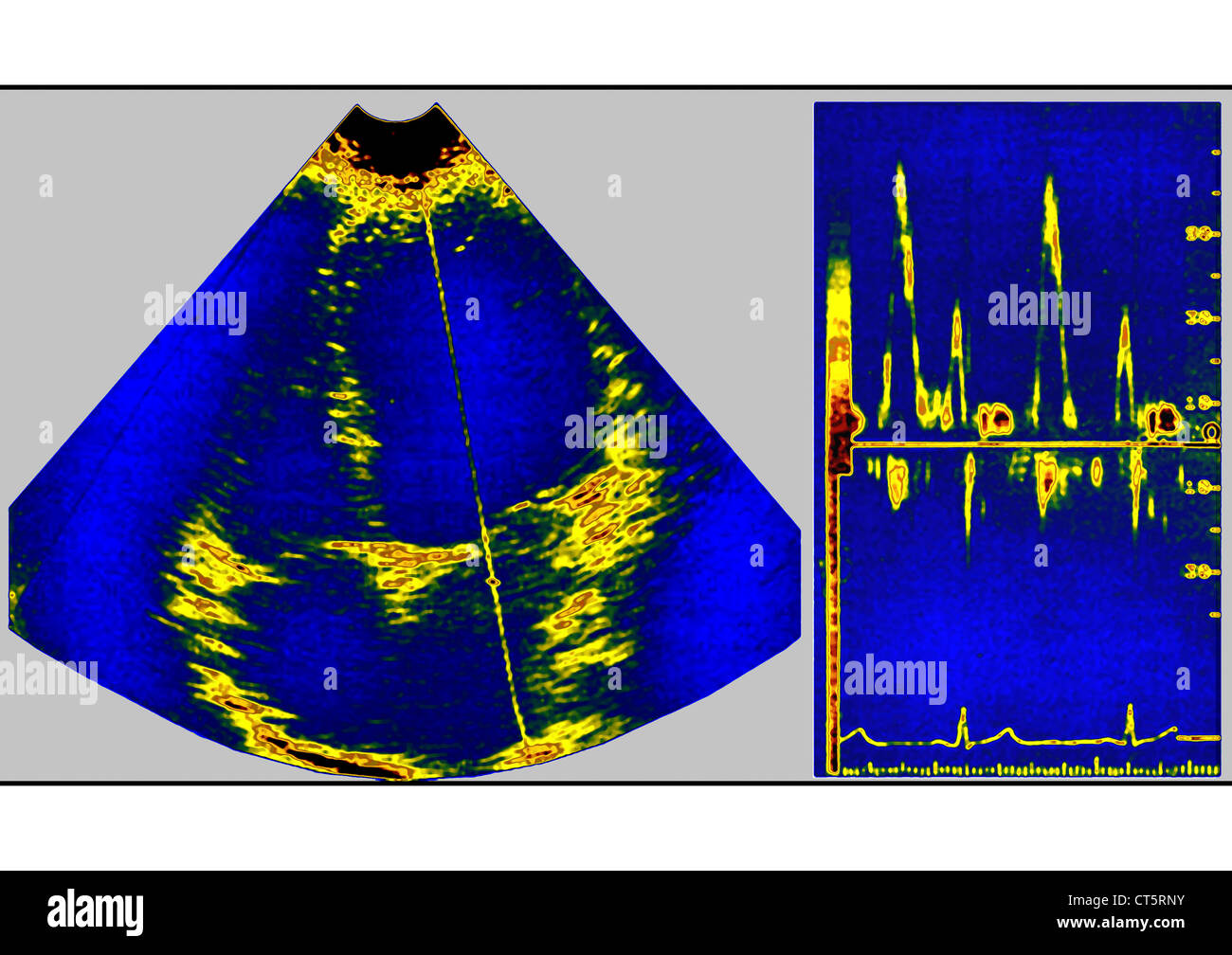Result heart test hi-res stock photography and images - Alamy