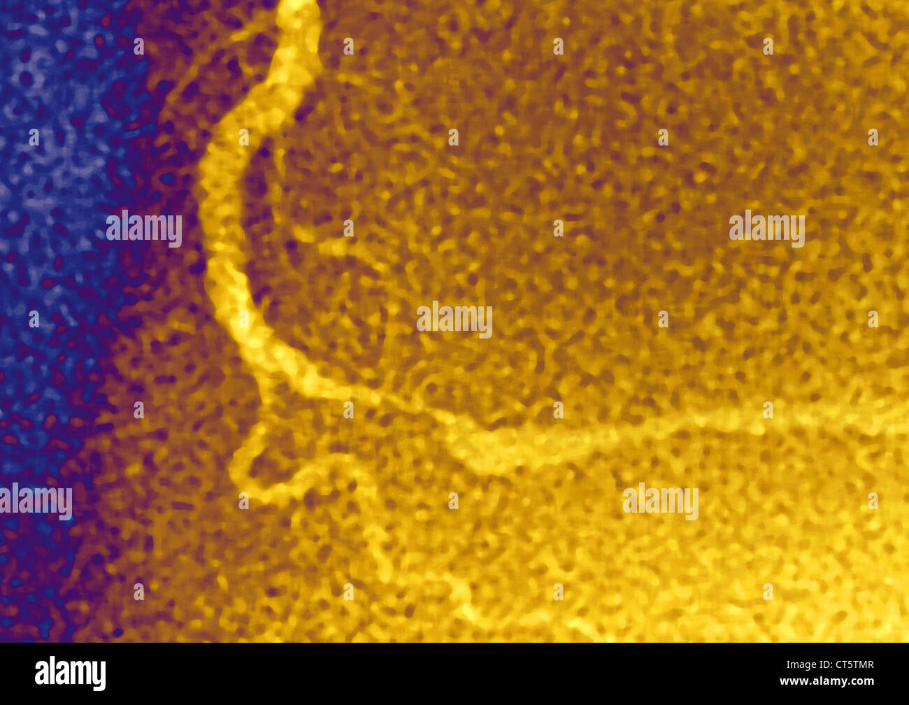 MYOCARDIAL INFARCTION, ANGIOGRA Stock Photo - Alamy