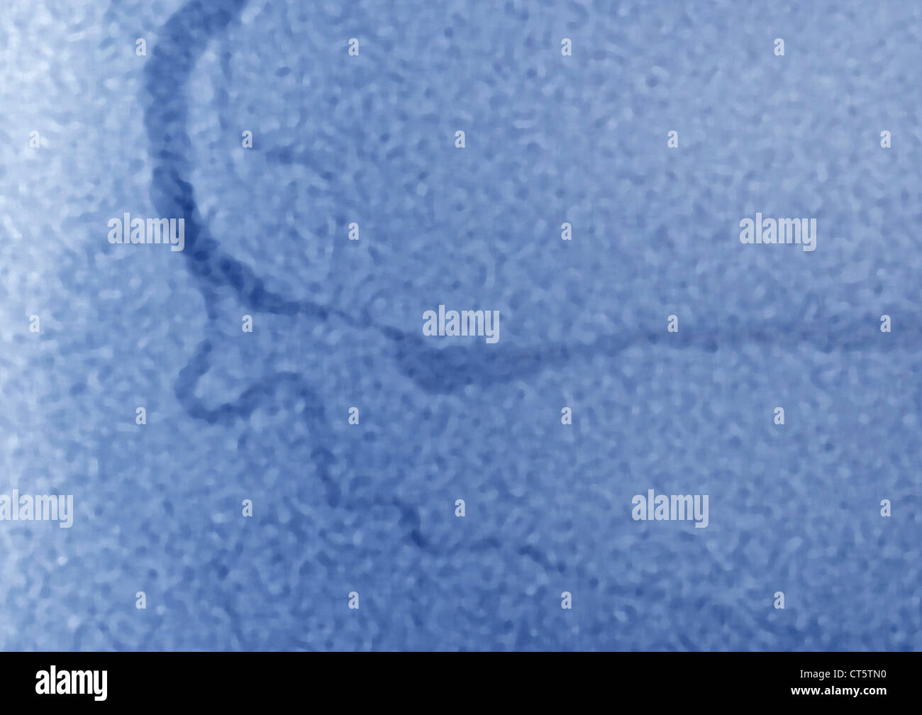 MYOCARDIAL INFARCTION, ANGIOGRA Stock Photo - Alamy