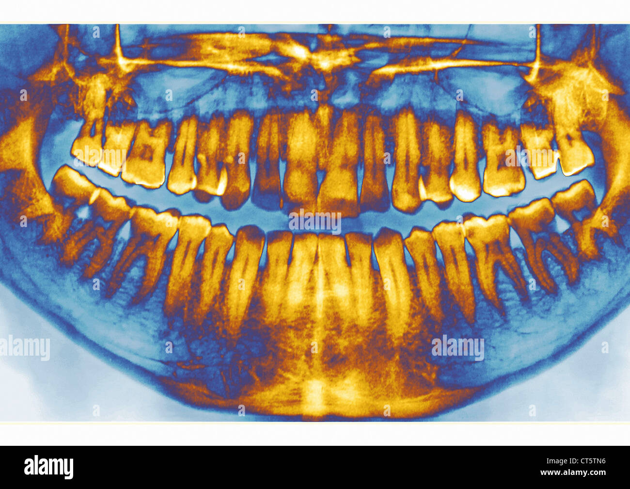 The result of dental radiography hi-res stock photography and images ...