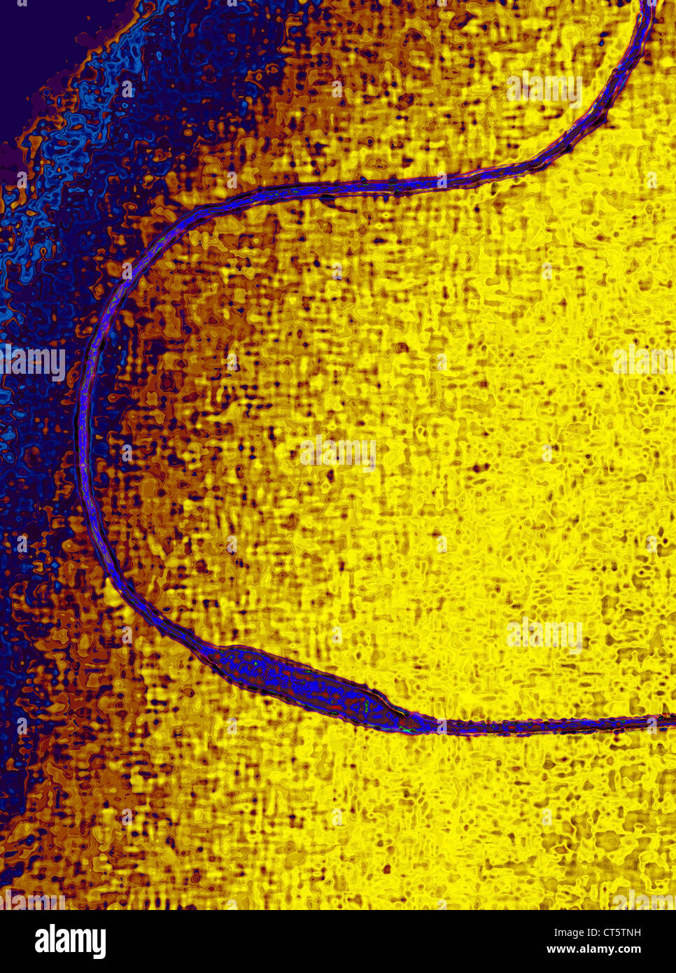 ARTERIAL ANGIOPLASTY, RESULT Stock Photo - Alamy ARTERIAL ANGIOPLASTY, RESULT Stock Photo - Alamy