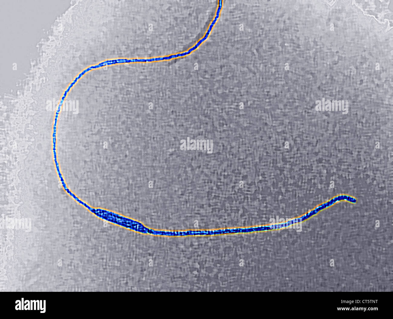ARTERIAL ANGIOPLASTY, RESULT Stock Photo - Alamy ARTERIAL ANGIOPLASTY, RESULT Stock Photo - Alamy