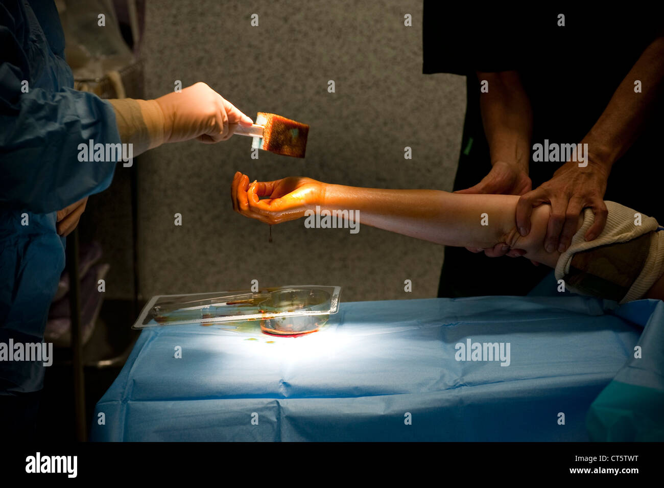 Carpal tunnel surgery hi-res stock photography and images - Alamy
