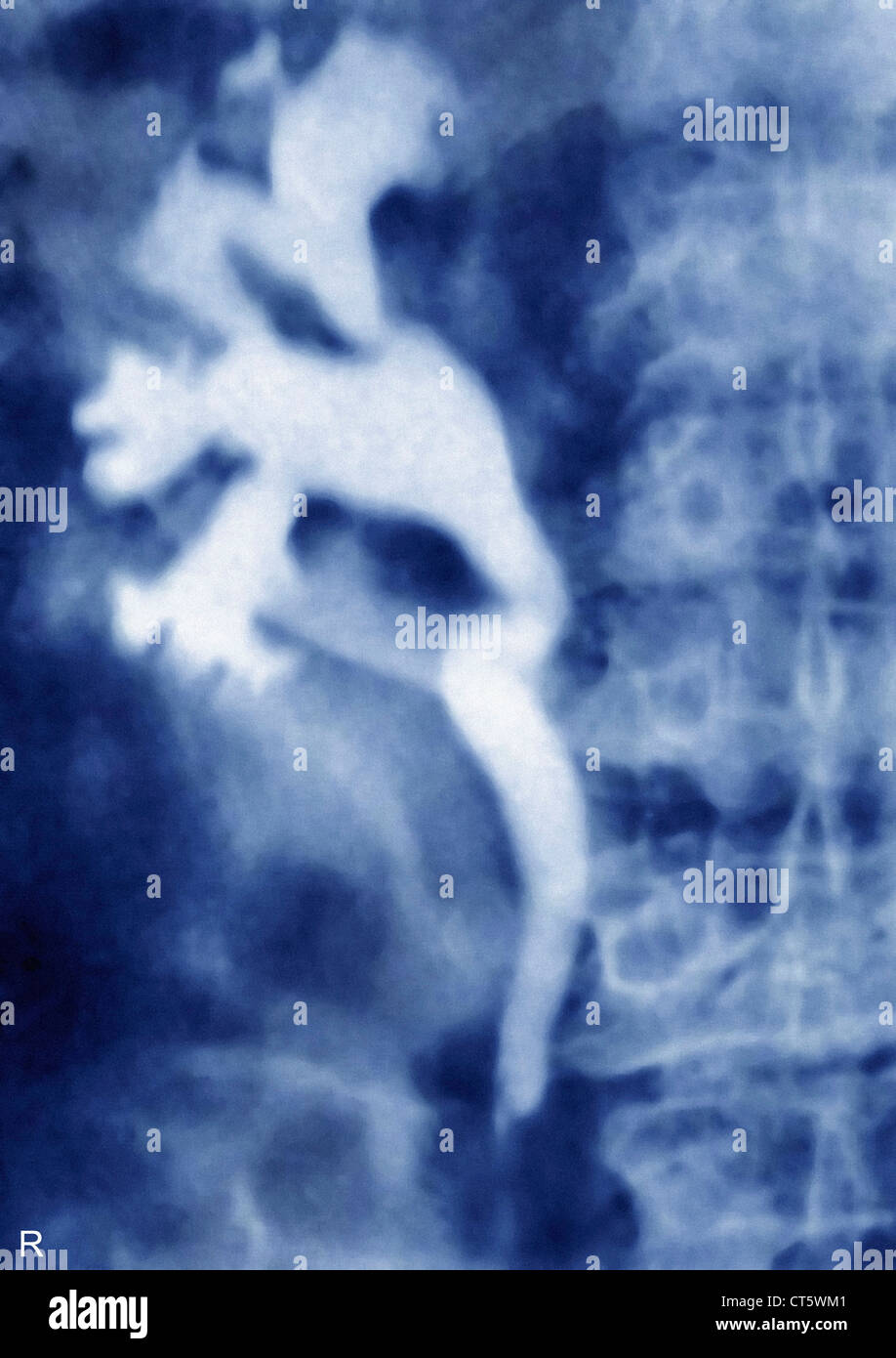 URETERAL LITHIASIS, X-RAY Stock Photo - Alamy