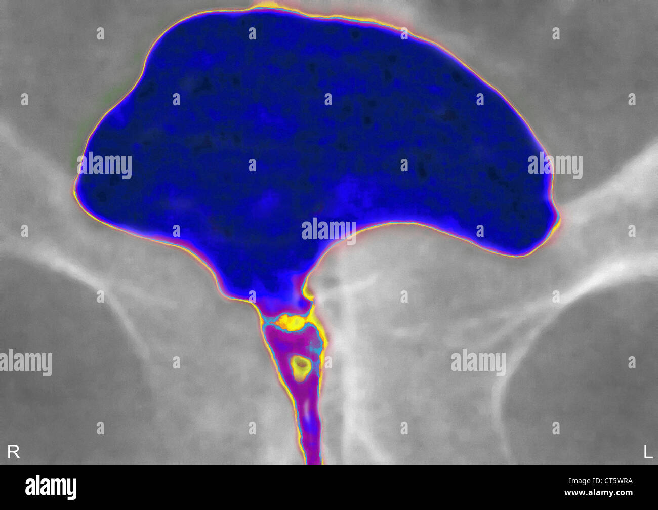 PROSTATIC CALCULUS, X-RAY Stock Photo - Alamy