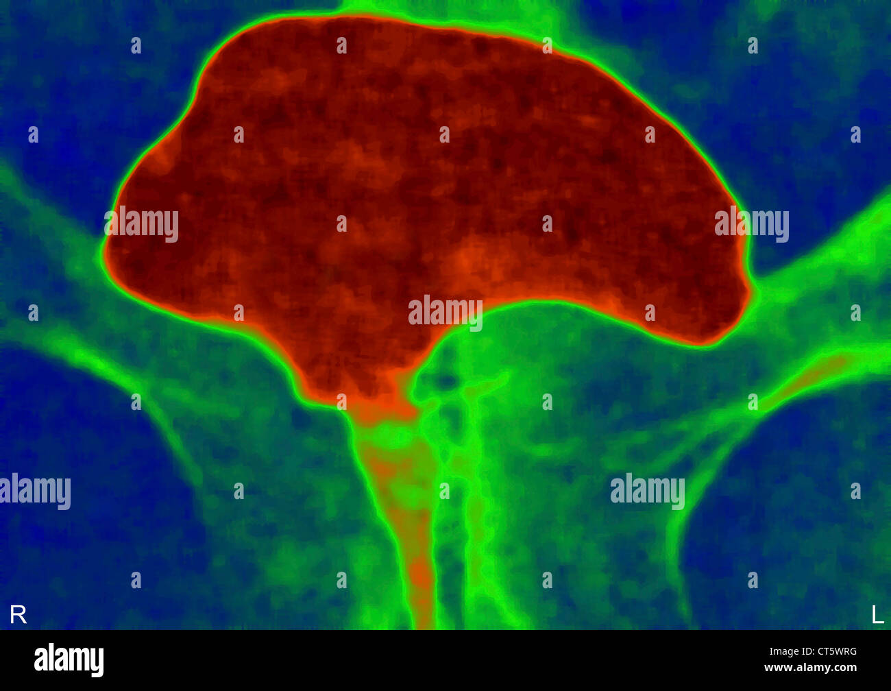 PROSTATIC CALCULUS, X-RAY Stock Photo - Alamy
