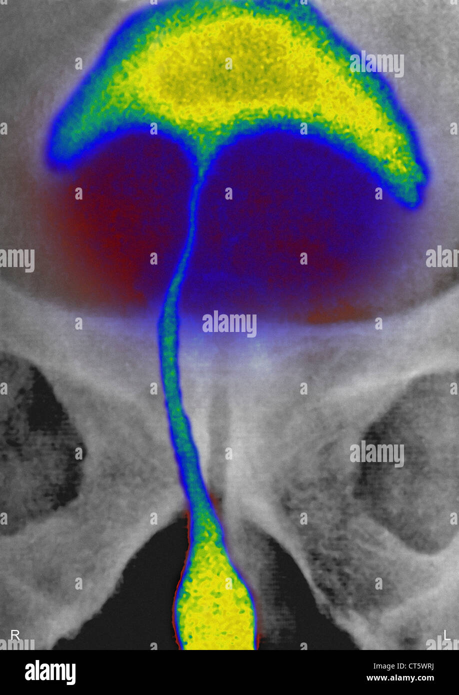 PROSTATIC ADENOMA, X-RAY Stock Photo - Alamy