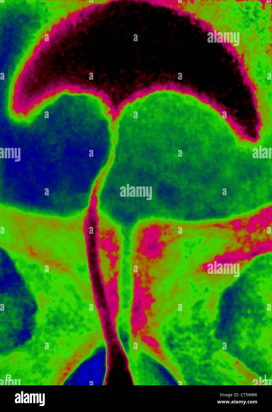 PROSTATIC ADENOMA, X-RAY Stock Photo - Alamy