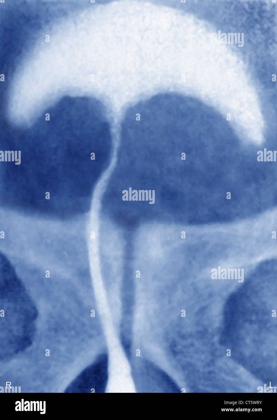 PROSTATIC ADENOMA, X-RAY Stock Photo - Alamy