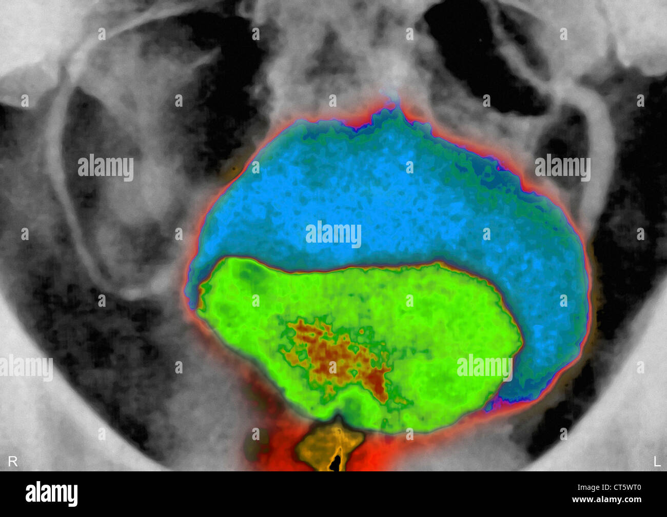 Prostate adenoma hi-res stock photography and images - Alamy