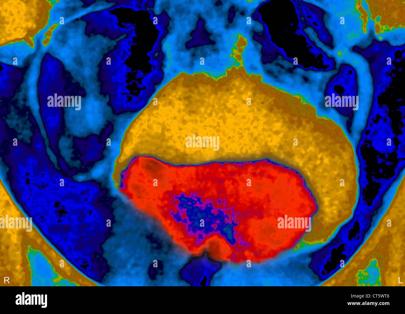 Prostatic adenoma x ray hi-res stock photography and images - Alamy
