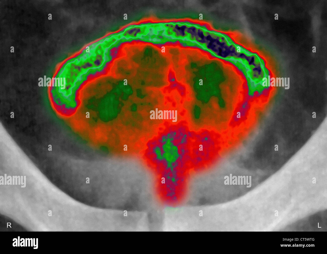 PROSTATIC ADENOMA, X-RAY Stock Photo - Alamy