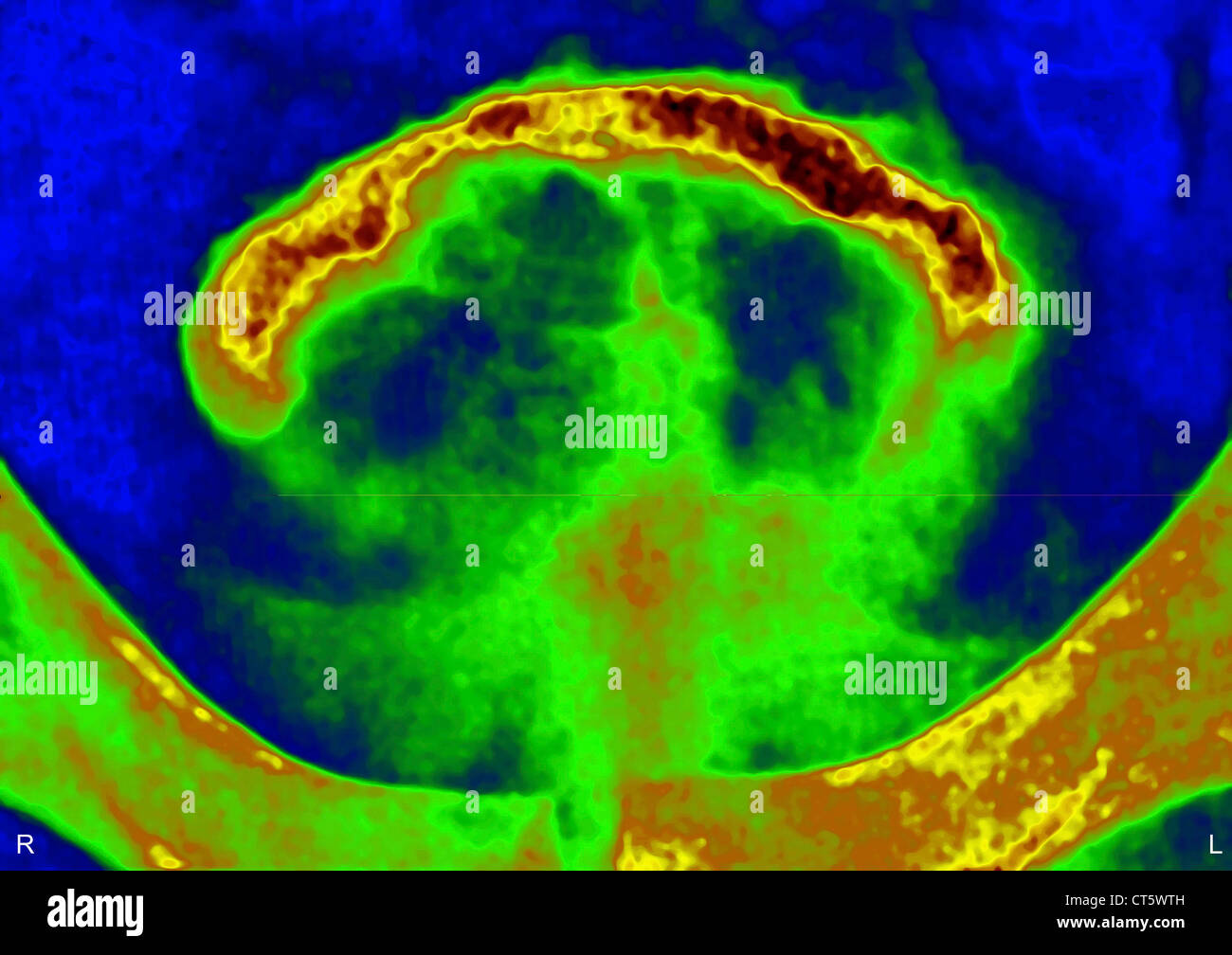 PROSTATIC ADENOMA, X-RAY Stock Photo - Alamy