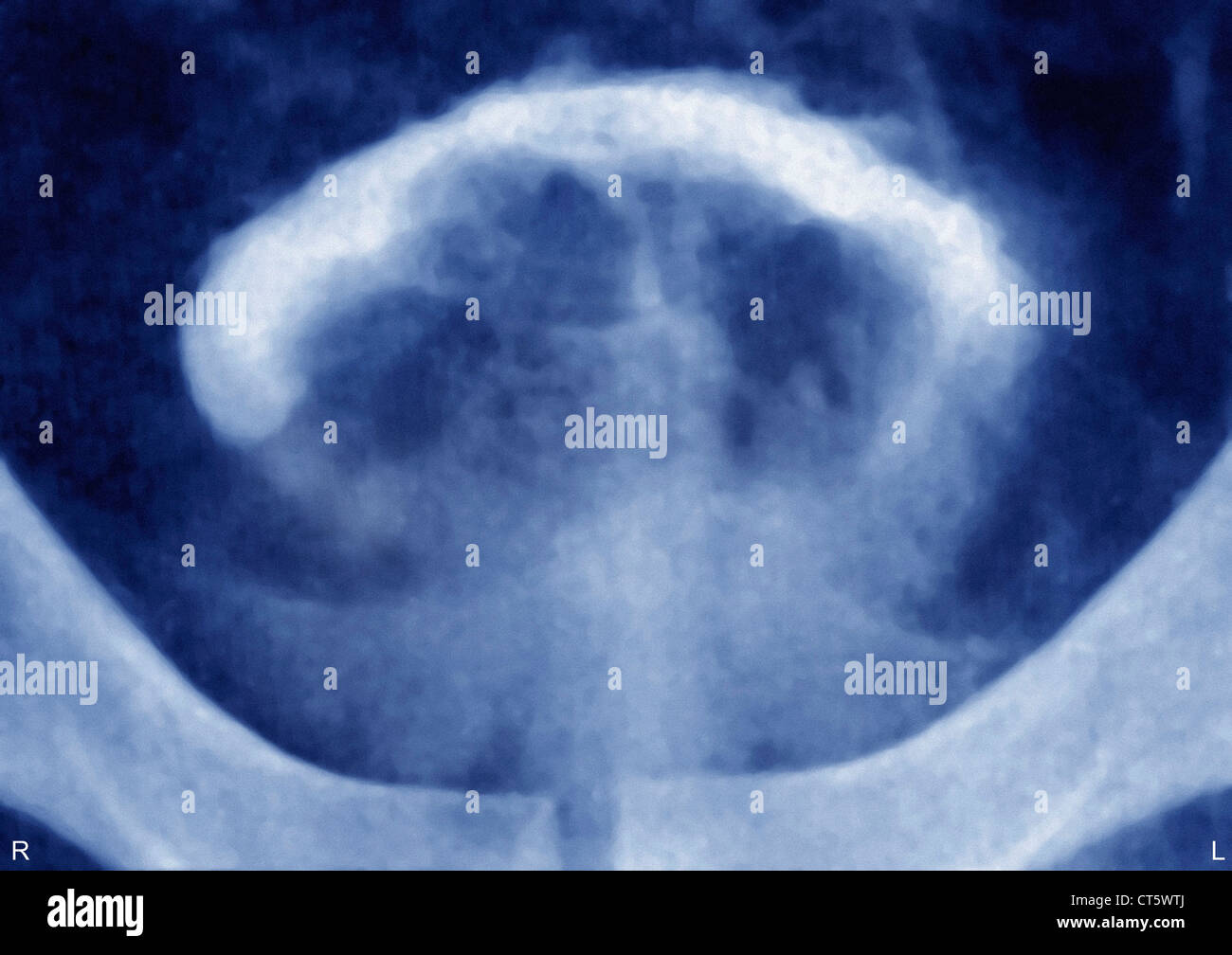 PROSTATIC ADENOMA, X-RAY Stock Photo - Alamy