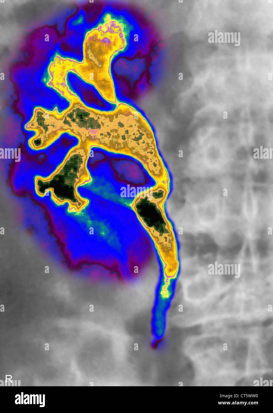 URETERAL LITHIASIS, X-RAY Stock Photo - Alamy