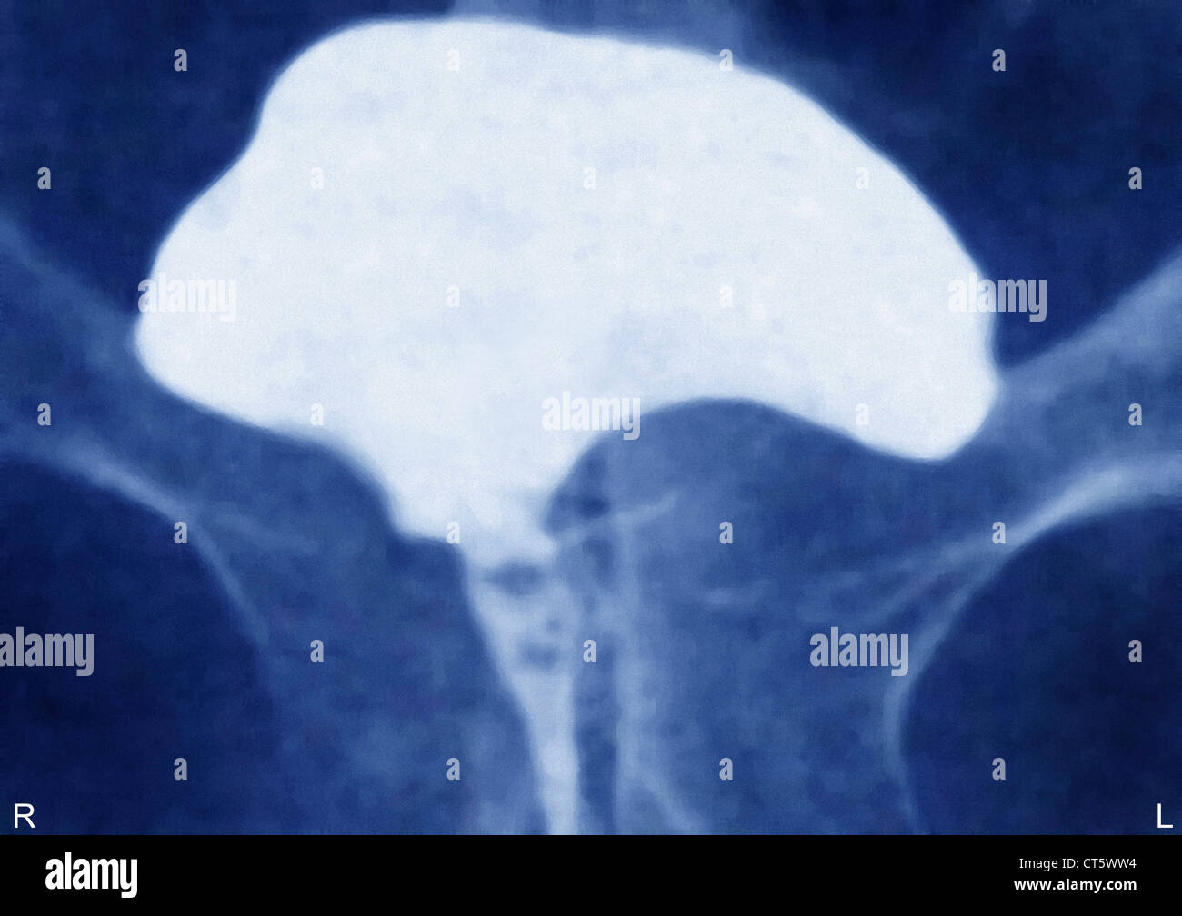 PROSTATIC CALCULUS, X-RAY Stock Photo - Alamy