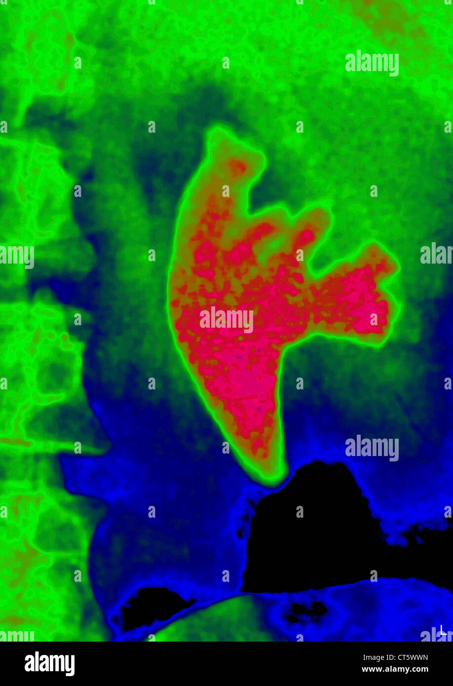 RENAL LITHIASIS, X-RAY Stock Photo - Alamy