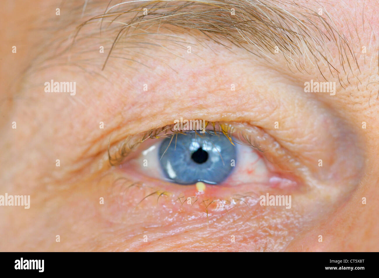 Stye eye hi-res stock photography and images - Alamy