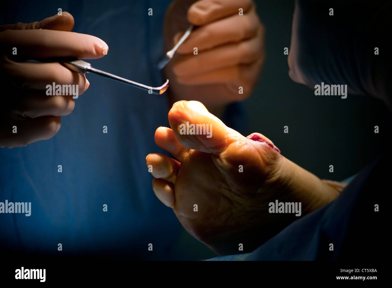 HALLUX VALGUS SURGERY Stock Photo - Alamy