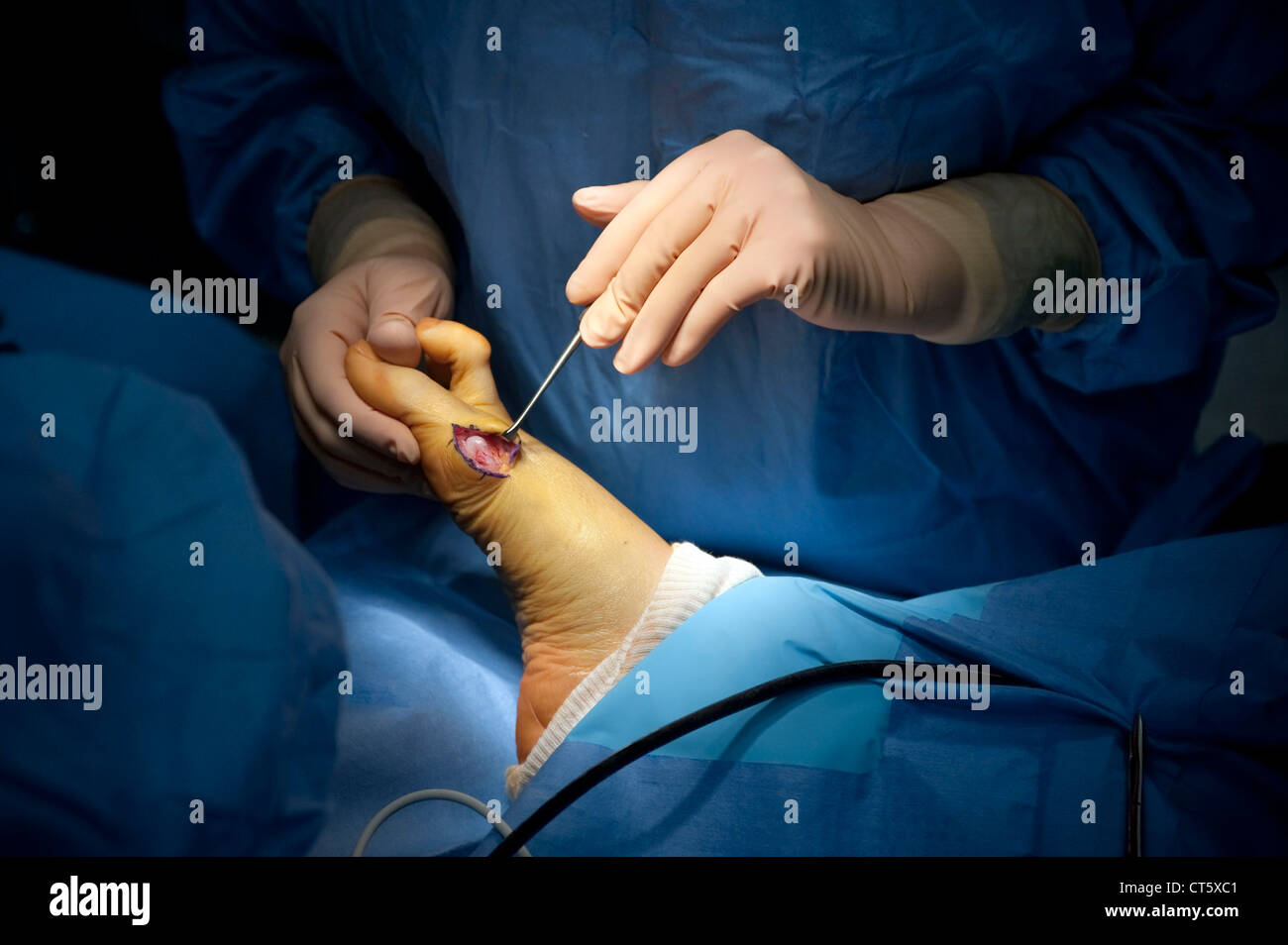 Hallux Valgus Surgery High Resolution Stock Photography and Images - Alamy