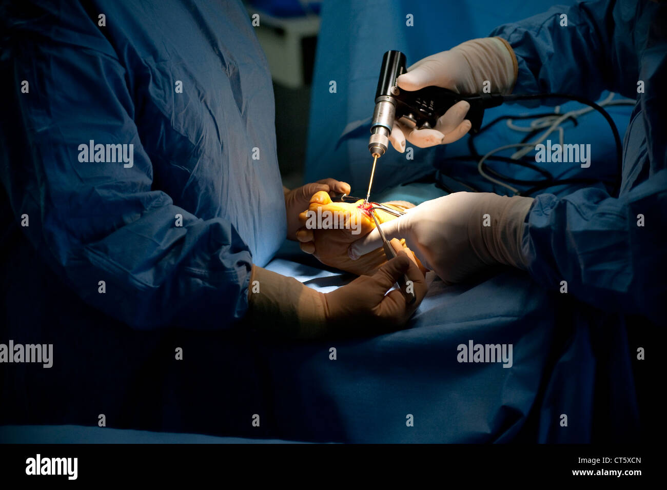 HALLUX VALGUS SURGERY Stock Photo - Alamy
