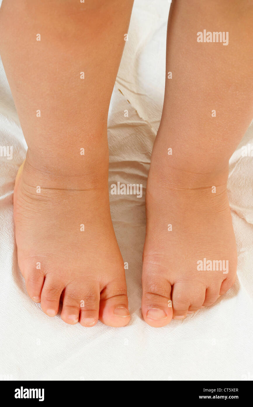 Syndactyly hi-res stock photography and images - Alamy