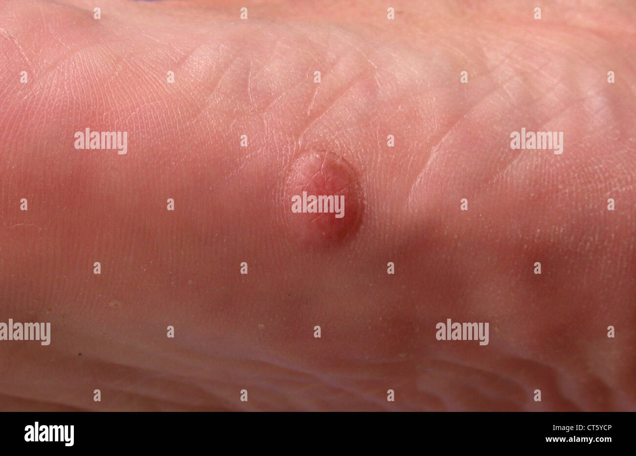 Metastatic cancers hi-res stock photography and images - Alamy