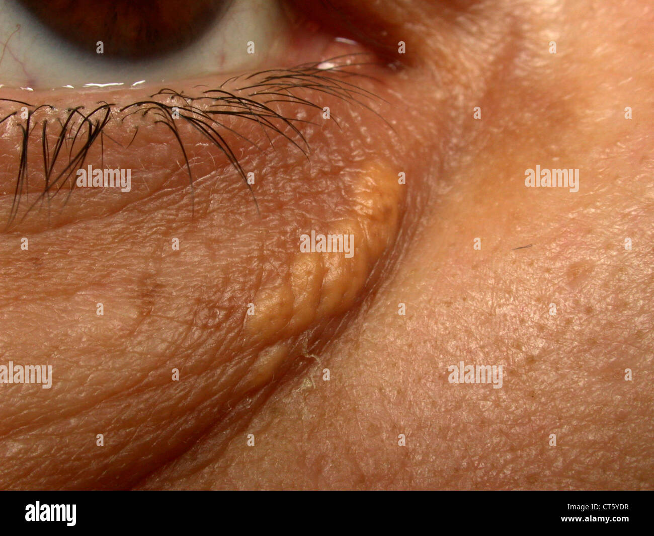 Xanthelasma hi-res stock photography and images - Alamy