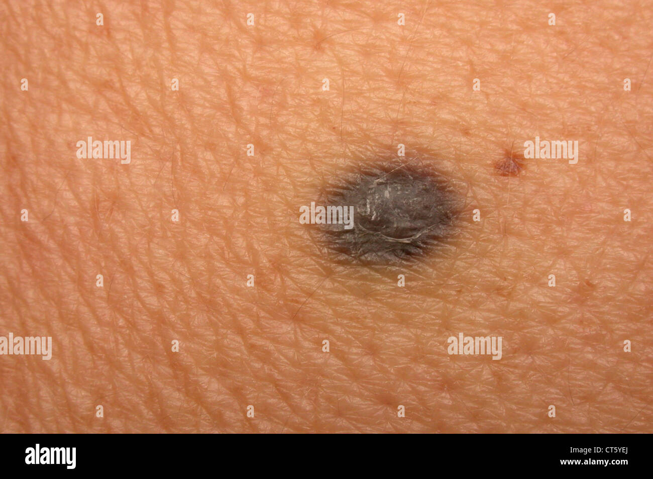 Pigmented naevus hi-res stock photography and images - Alamy
