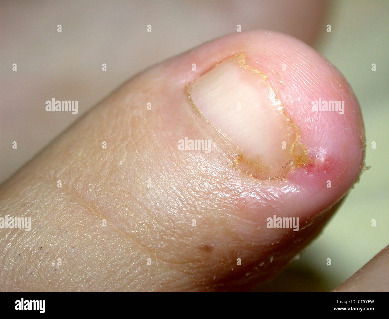 Ingrown toenails hi-res stock photography and images - Alamy