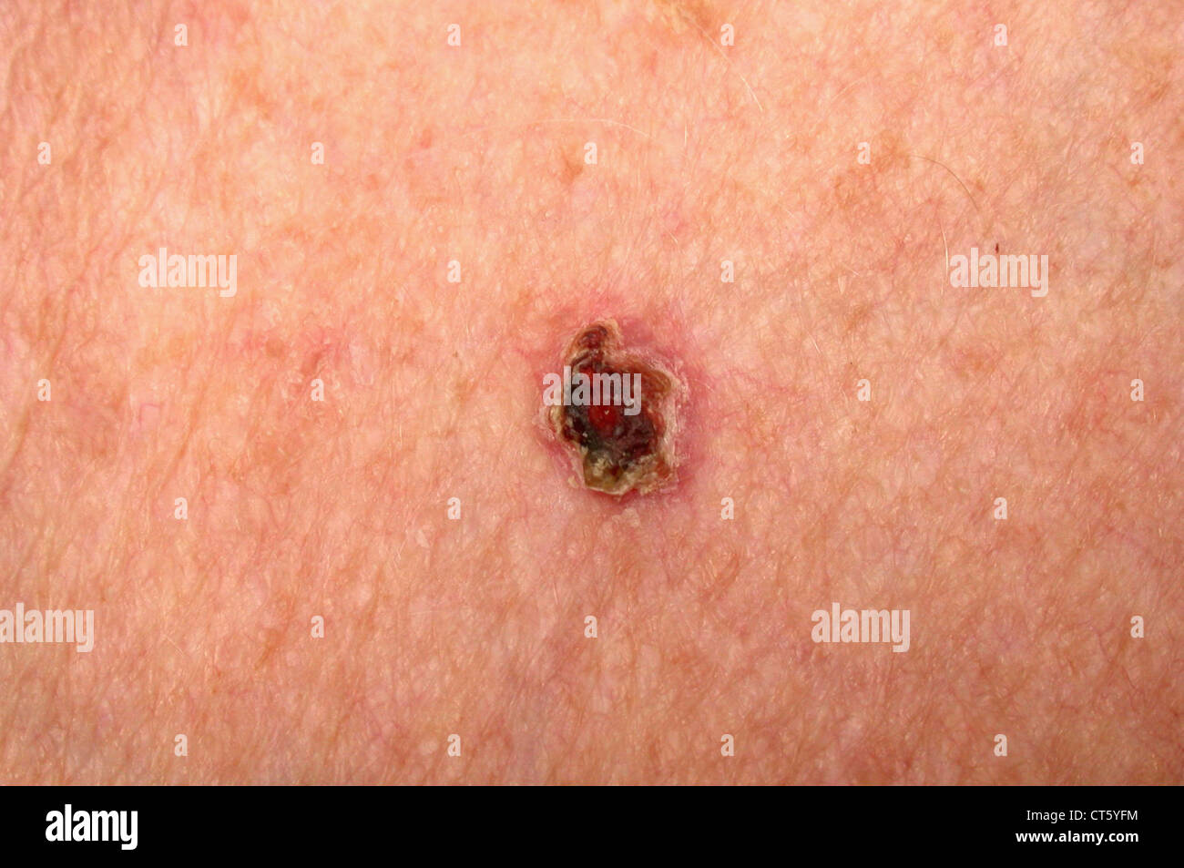 BASAL CELL CARCINOMA Stock Photo - Alamy
