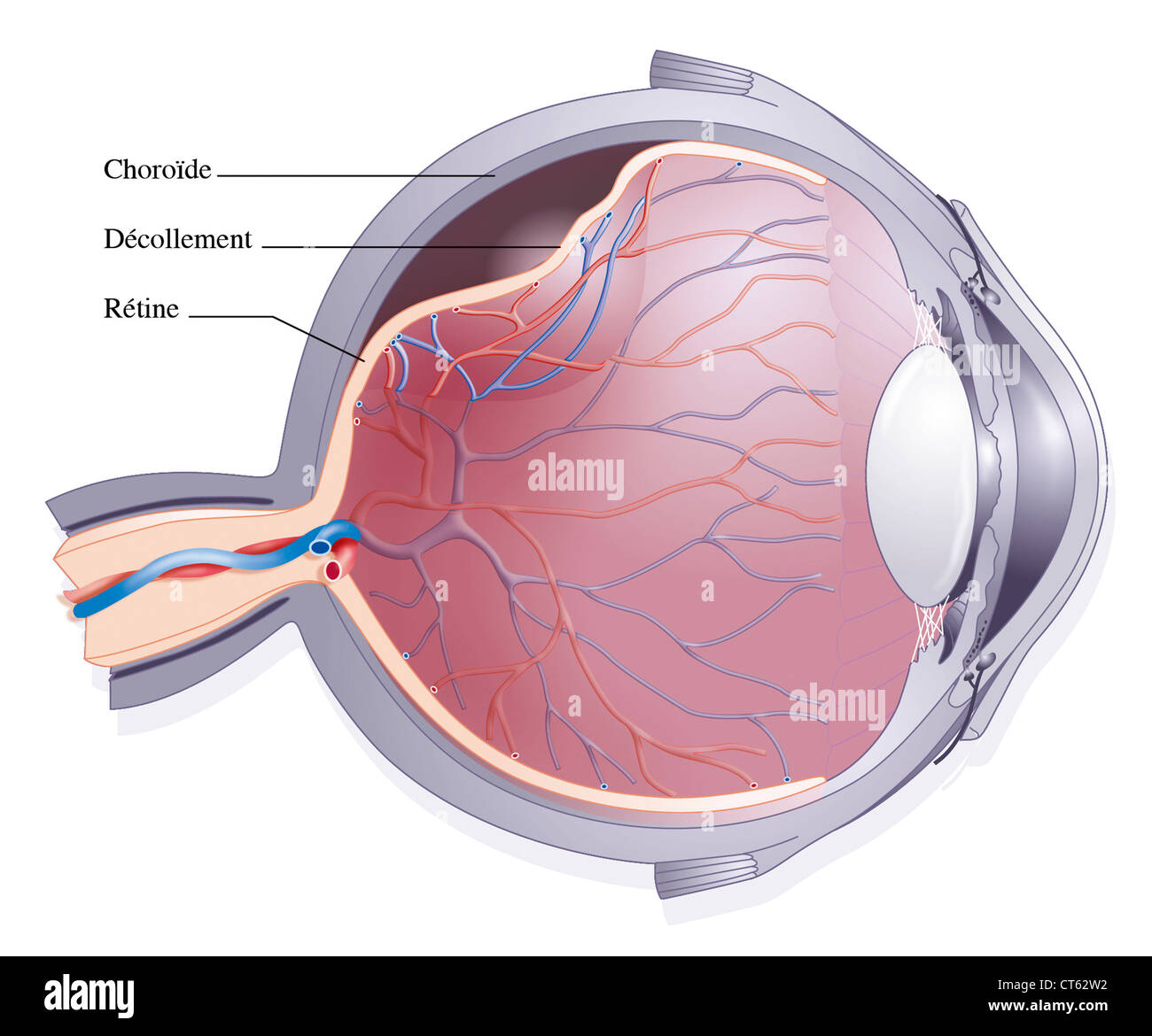 RETINAL DETACHMENT, ILLUSTRATION Stock Photo - Alamy