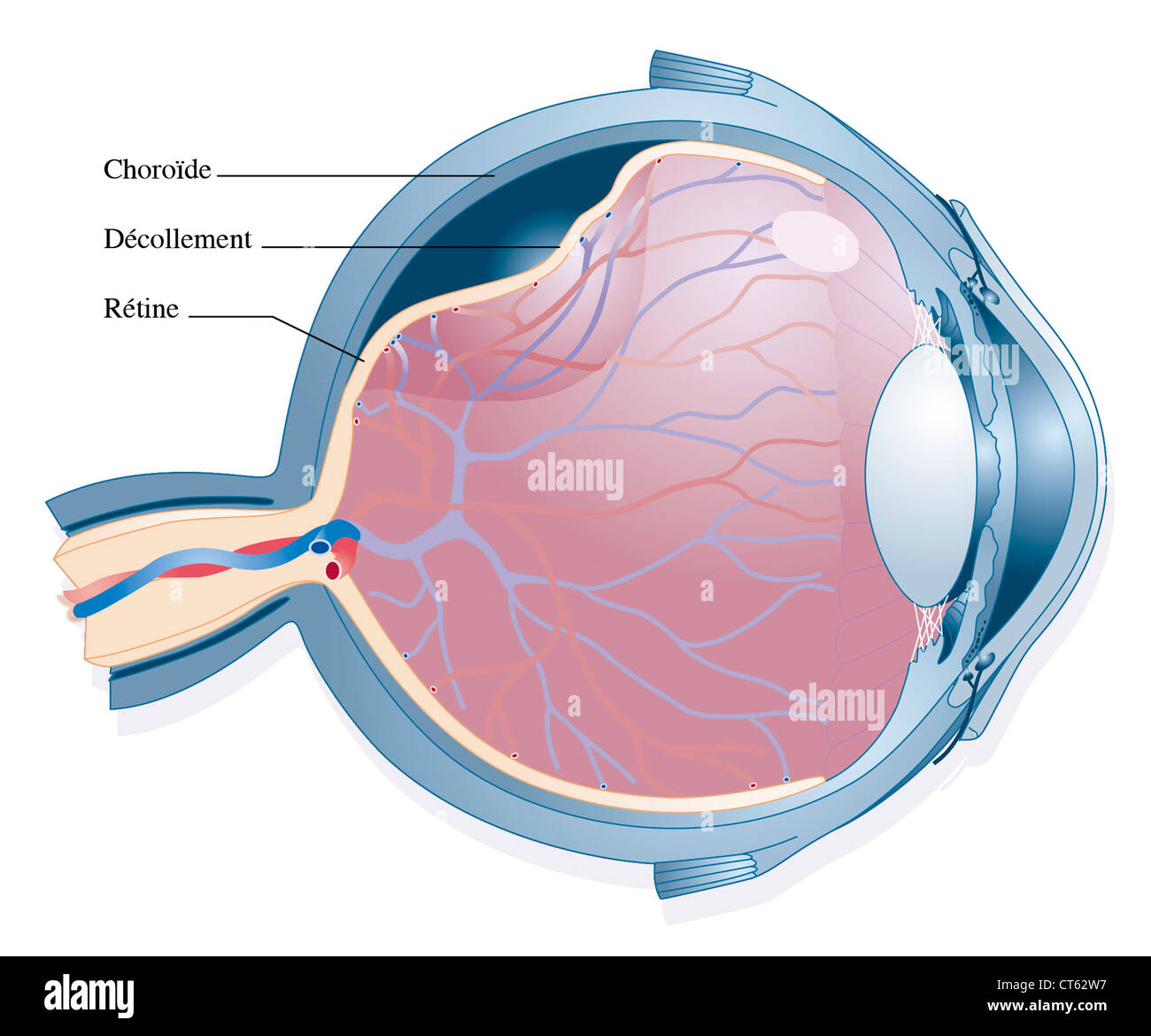 RETINAL DETACHMENT, ILLUSTRATION Stock Photo - Alamy