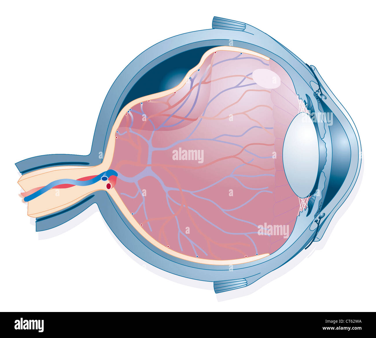 RETINAL DETACHMENT, ILLUSTRATION Stock Photo - Alamy