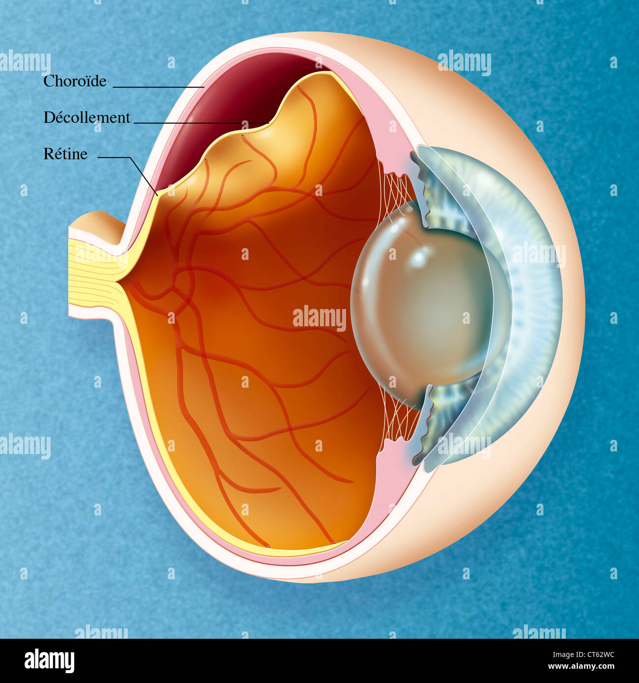 Choroidal retinal hi-res stock photography and images - Alamy